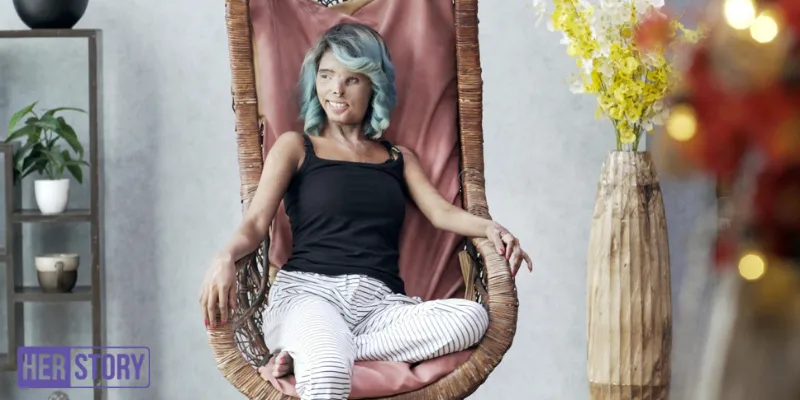 Burnt as a baby, this acid attack survivor is now a fashion model ...